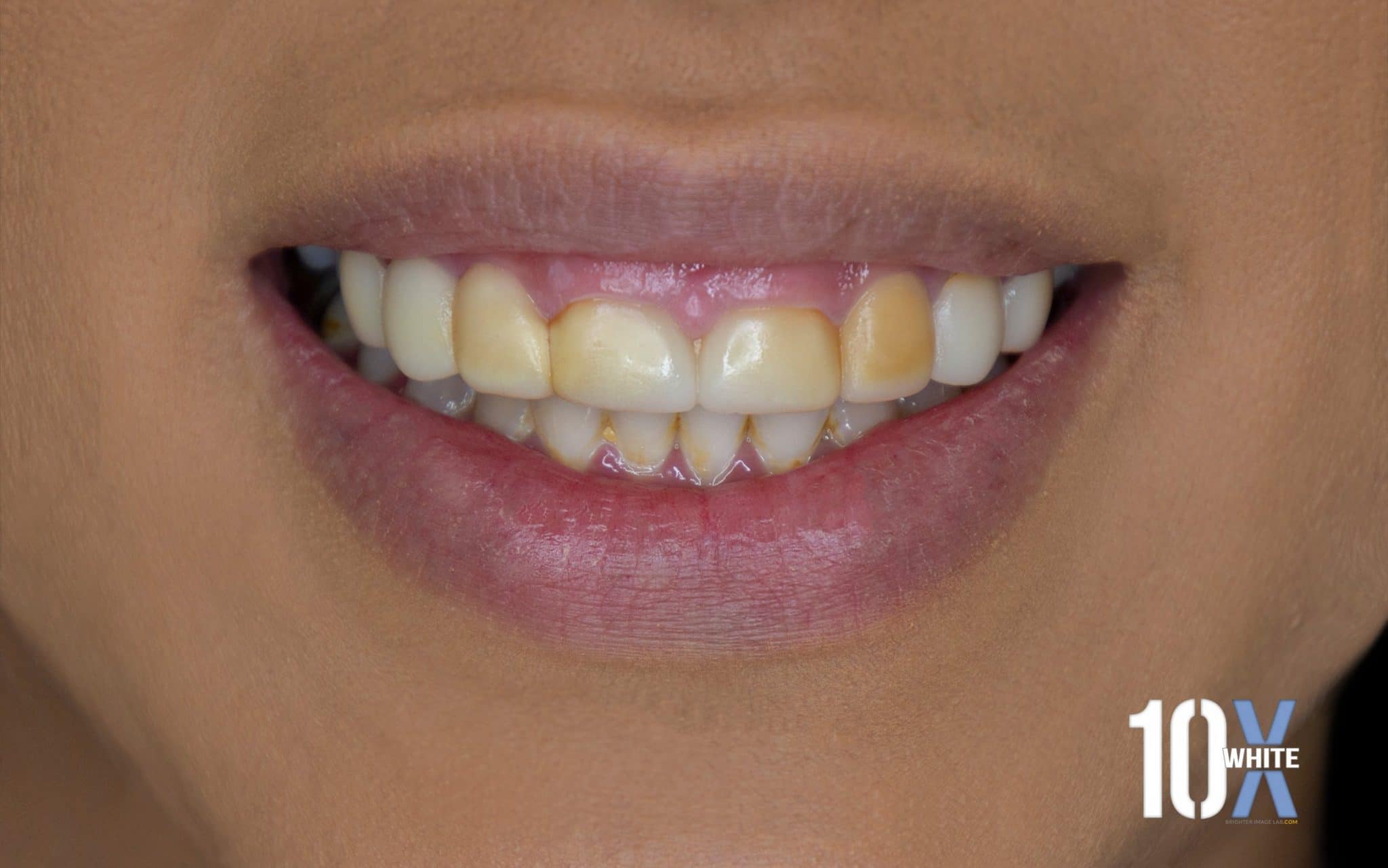 Wine Stains Begone! Getting a Whiter Smile with 1 Simple Solution ...